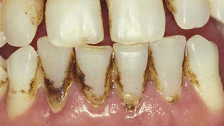 Cuando vuelvas al dentista reclámale porque jamás te dijo que esto ...