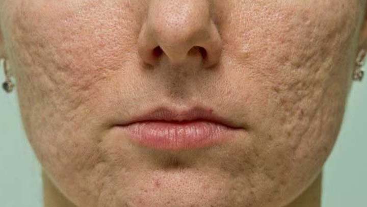 Magia blanca, una crema para quitar el acné más profundo y blanquear el ...